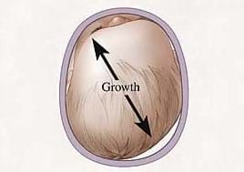 3D Head Shape Assessment for your baby's flat head plagiocephaly
